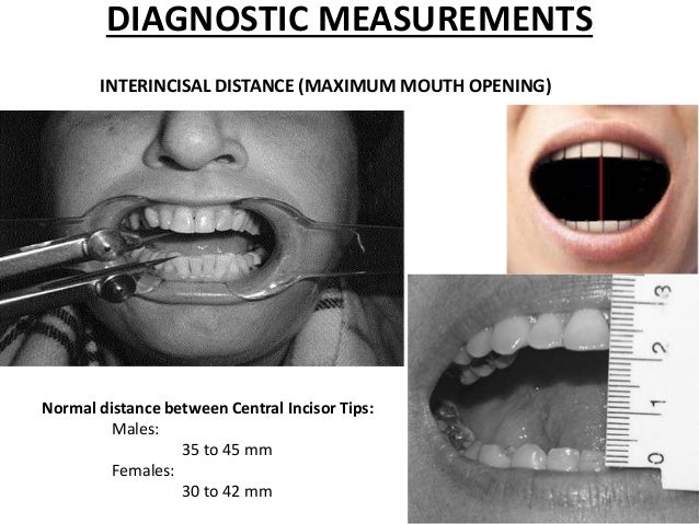 Oral Submucous Fibrosis and its Management.