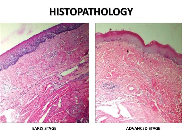 Oral Submucous Fibrosis Histopathology