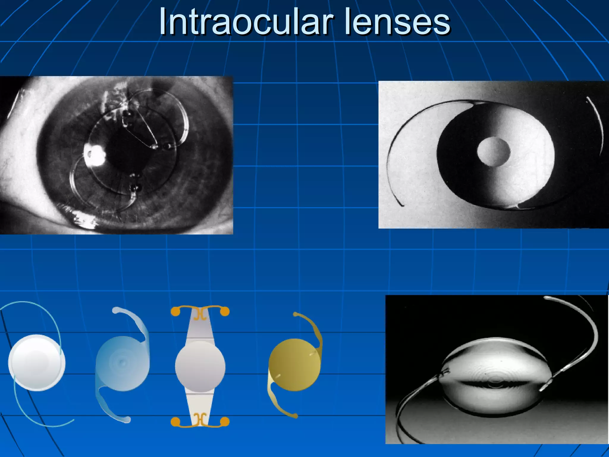 Pathology of lens. Glaucoma | PPT