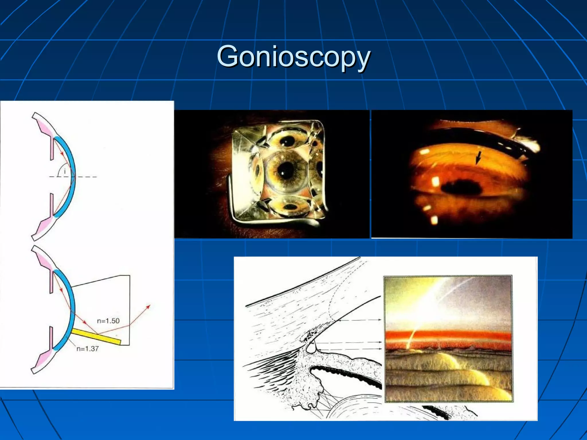 Pathology of lens. Glaucoma | PPT