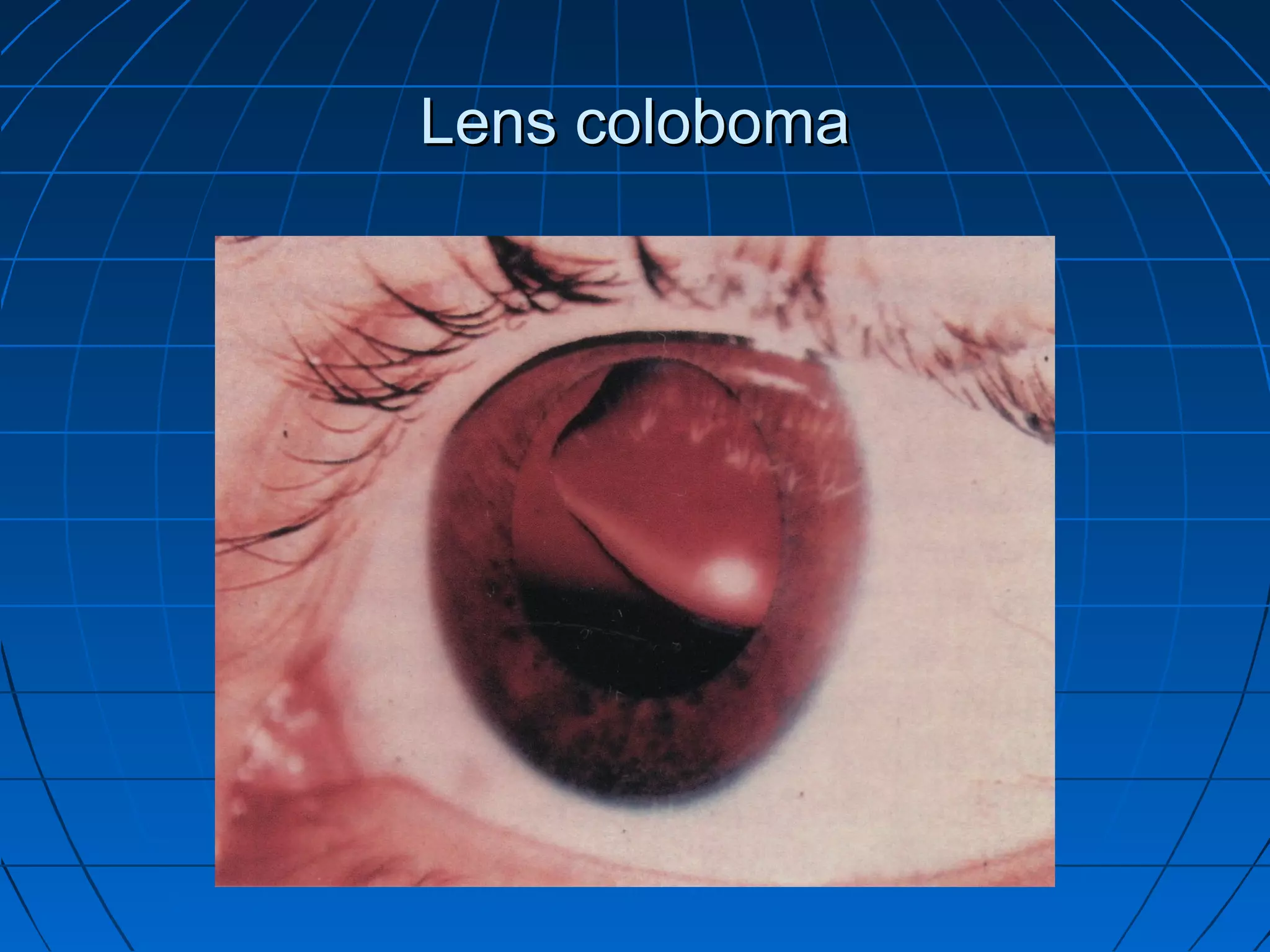 Pathology Of Lens Glaucoma Ppt