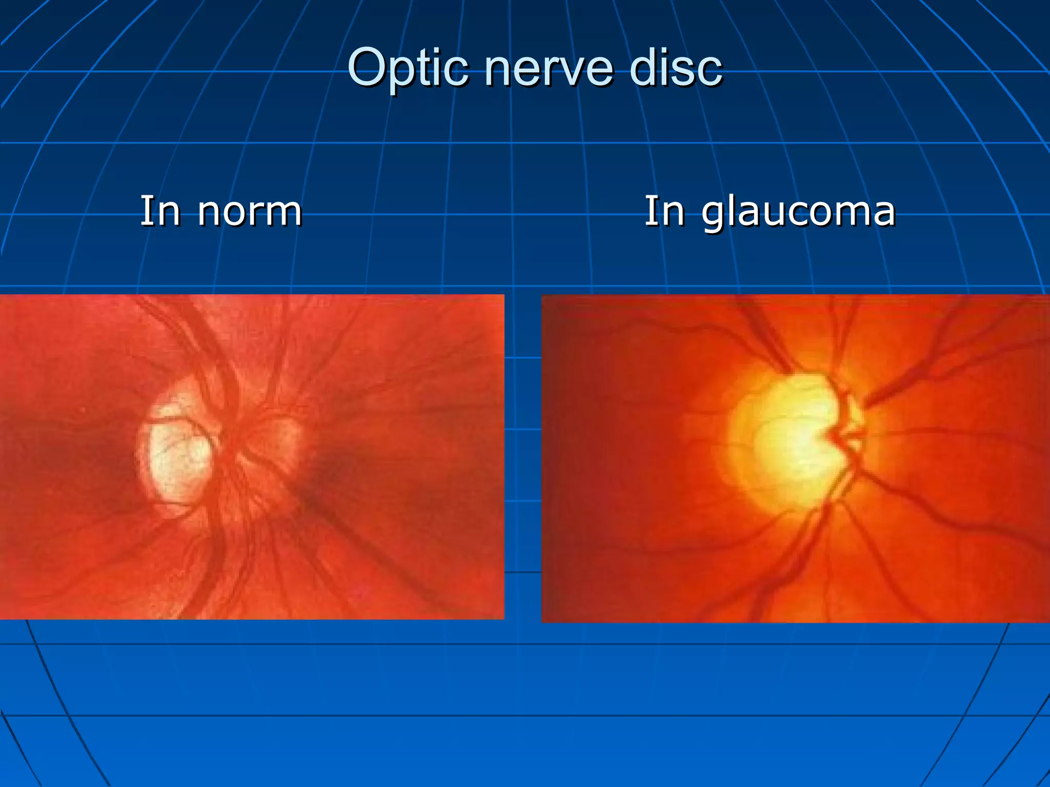 Pathology of lens. Glaucoma | PPT