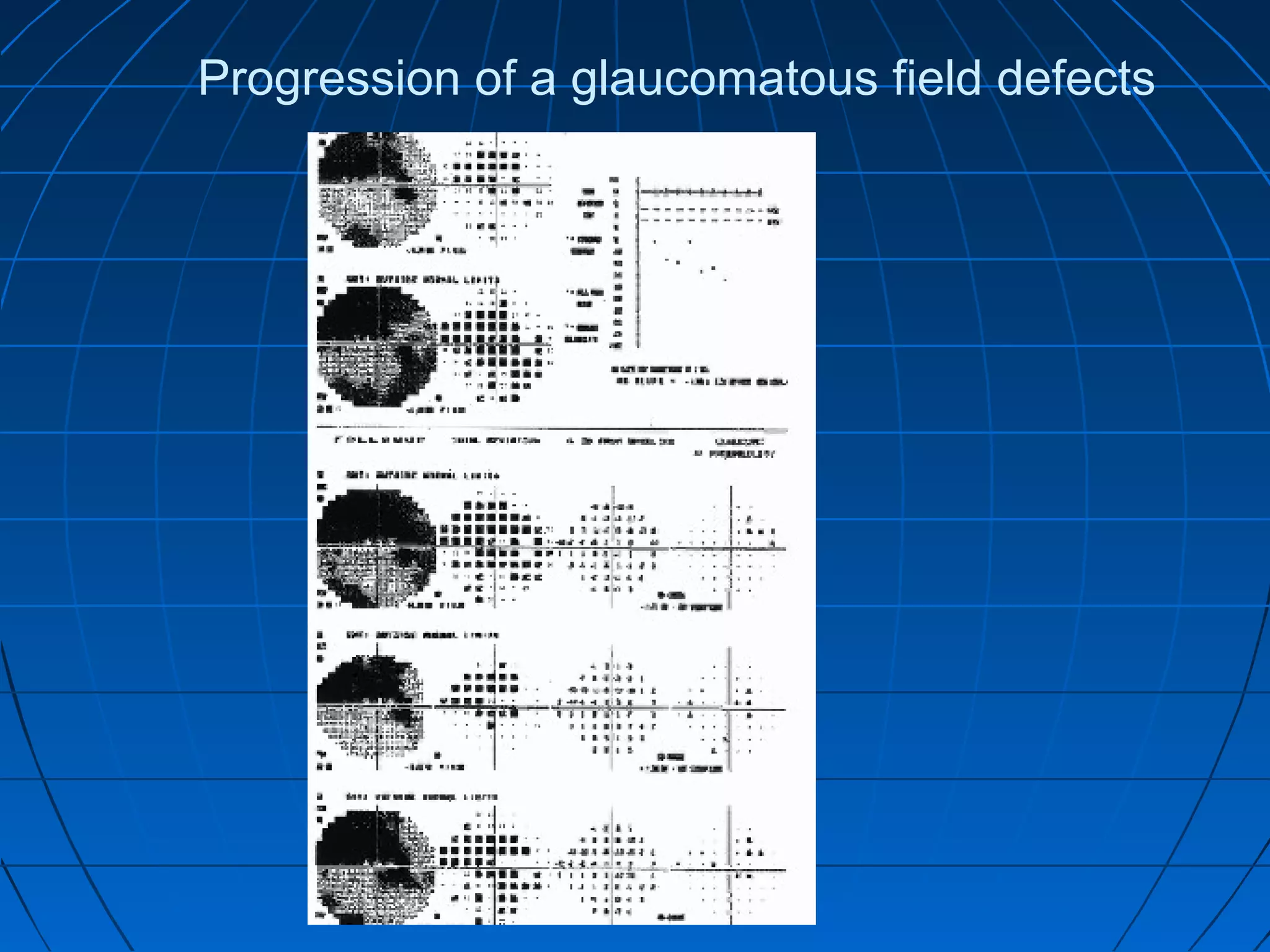 Pathology of lens. Glaucoma | PPT