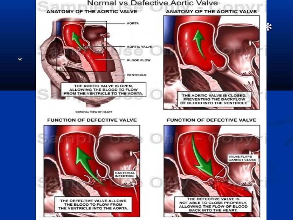 Aortic regurgitation (Aortic Insufficiency)