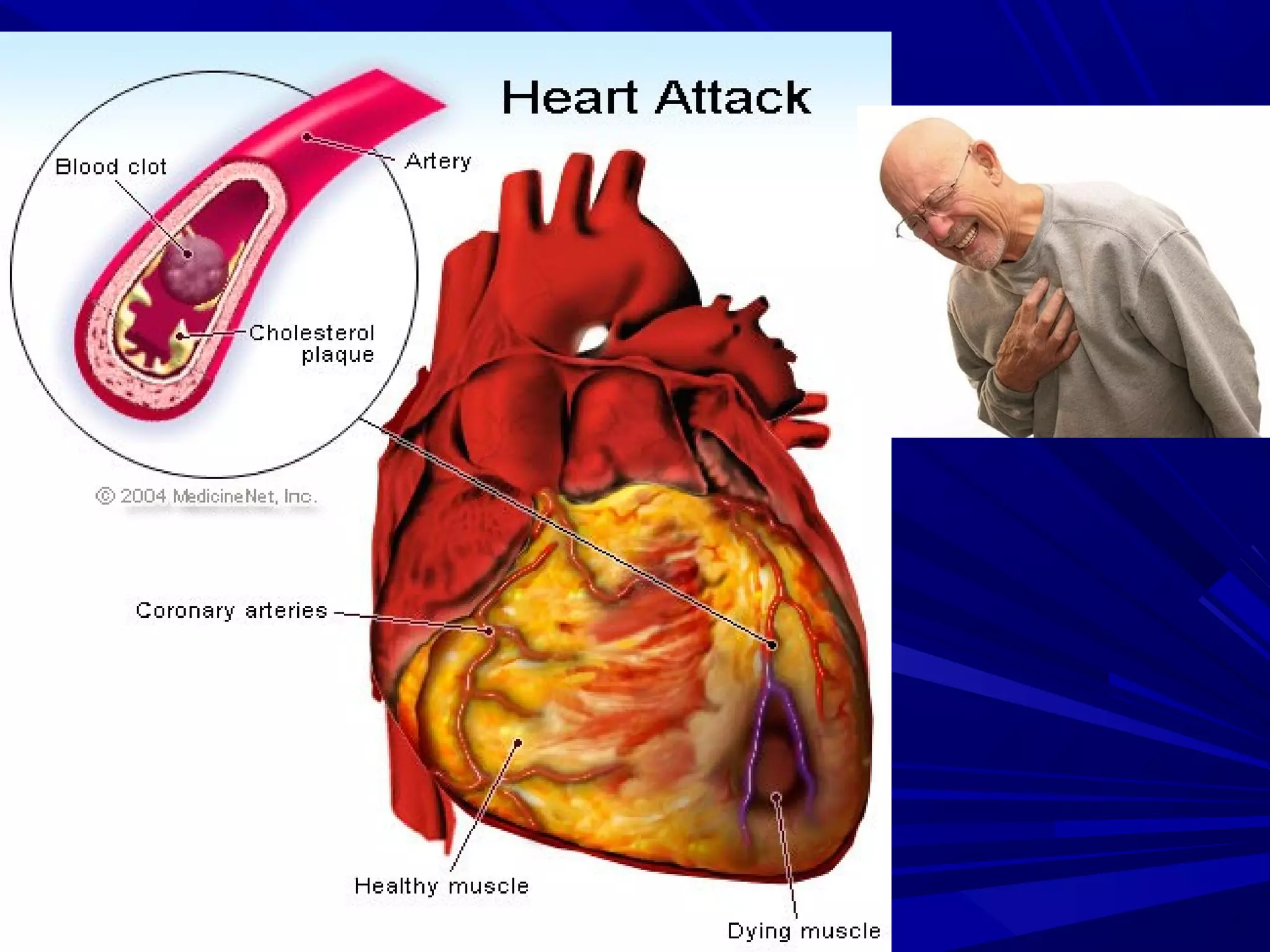Acute Myocardial Infarction | PPT
