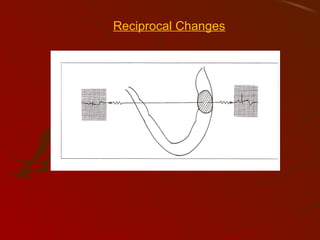 Acute Myocardial Infarction | PPT