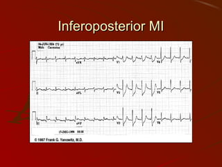 Acute Myocardial Infarction | PPT