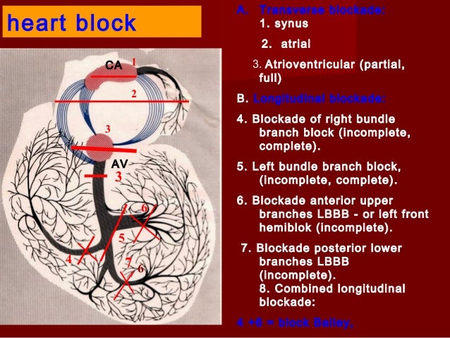 Heart Block