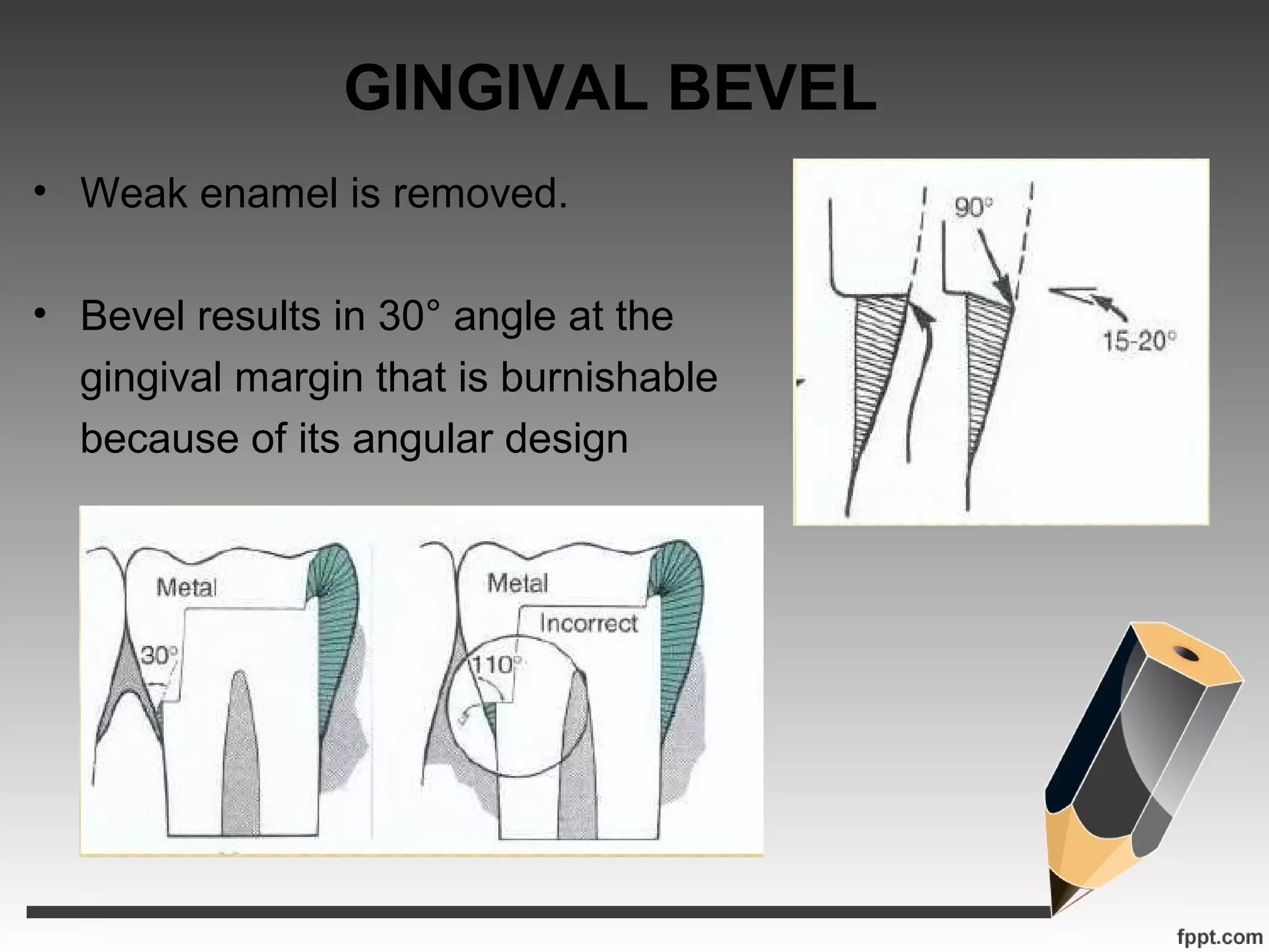 Bevels and flares in dental restoration | PPT