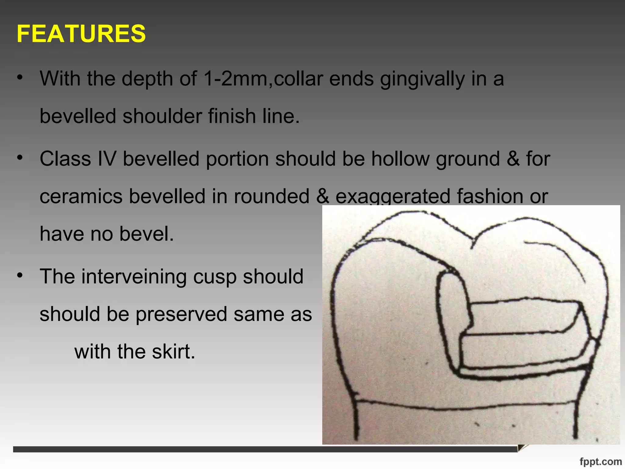 Bevels and flares in dental restoration | PPT