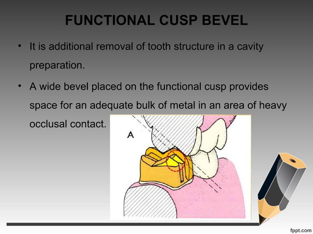Bevels and flares in dental restoration | PPT | Dental Health ...