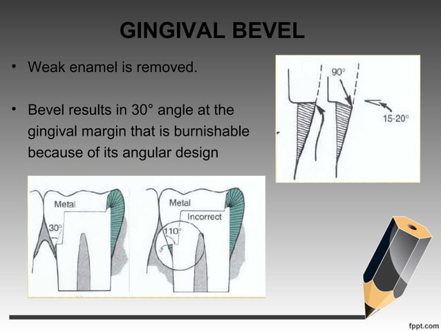 Bevels and flares in dental restoration | PPT | Dental Health ...