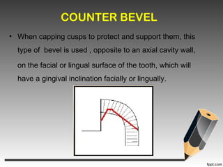 Bevels and flares in dental restoration | PPT