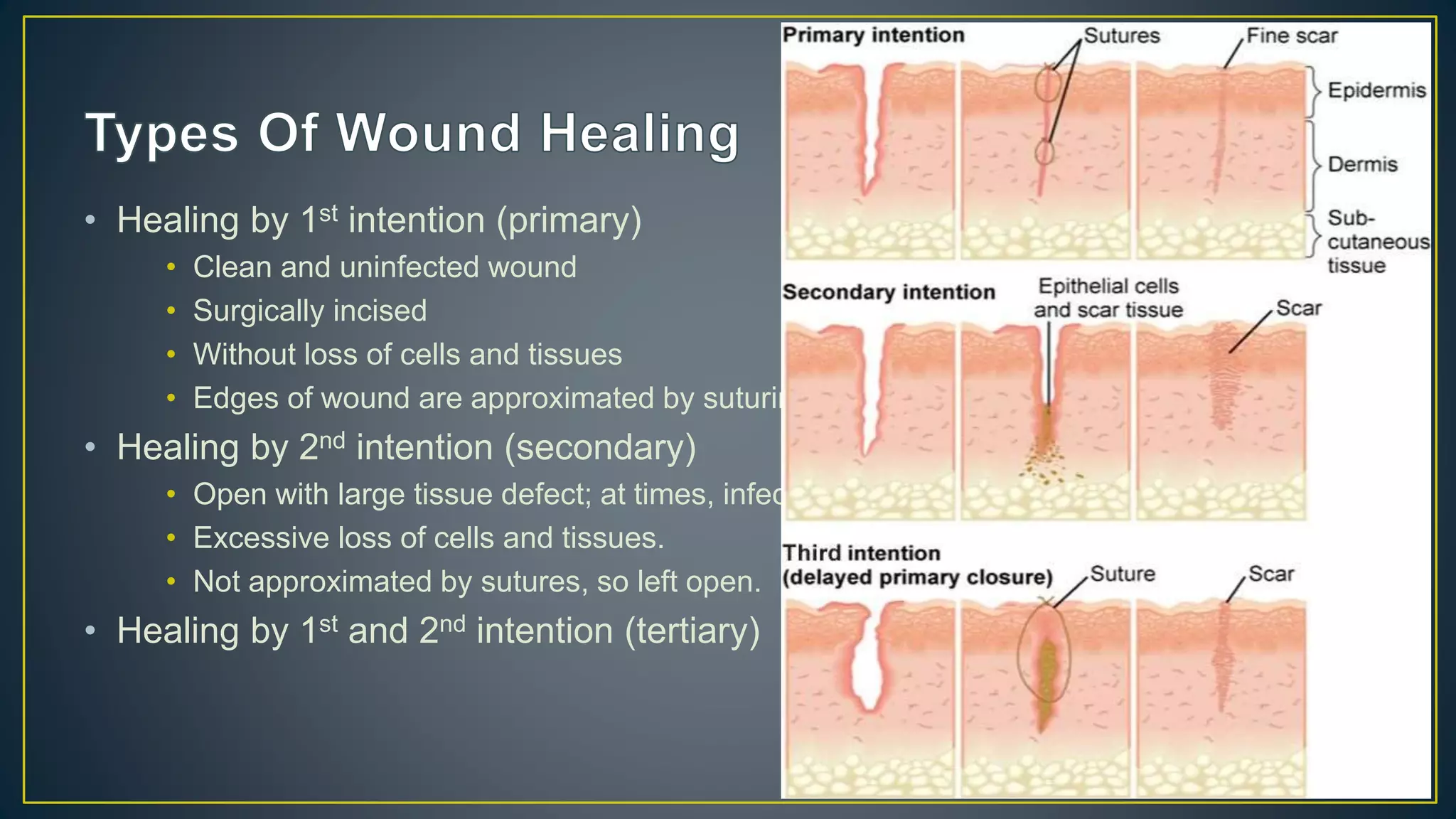 4. healing and fracture | PPT