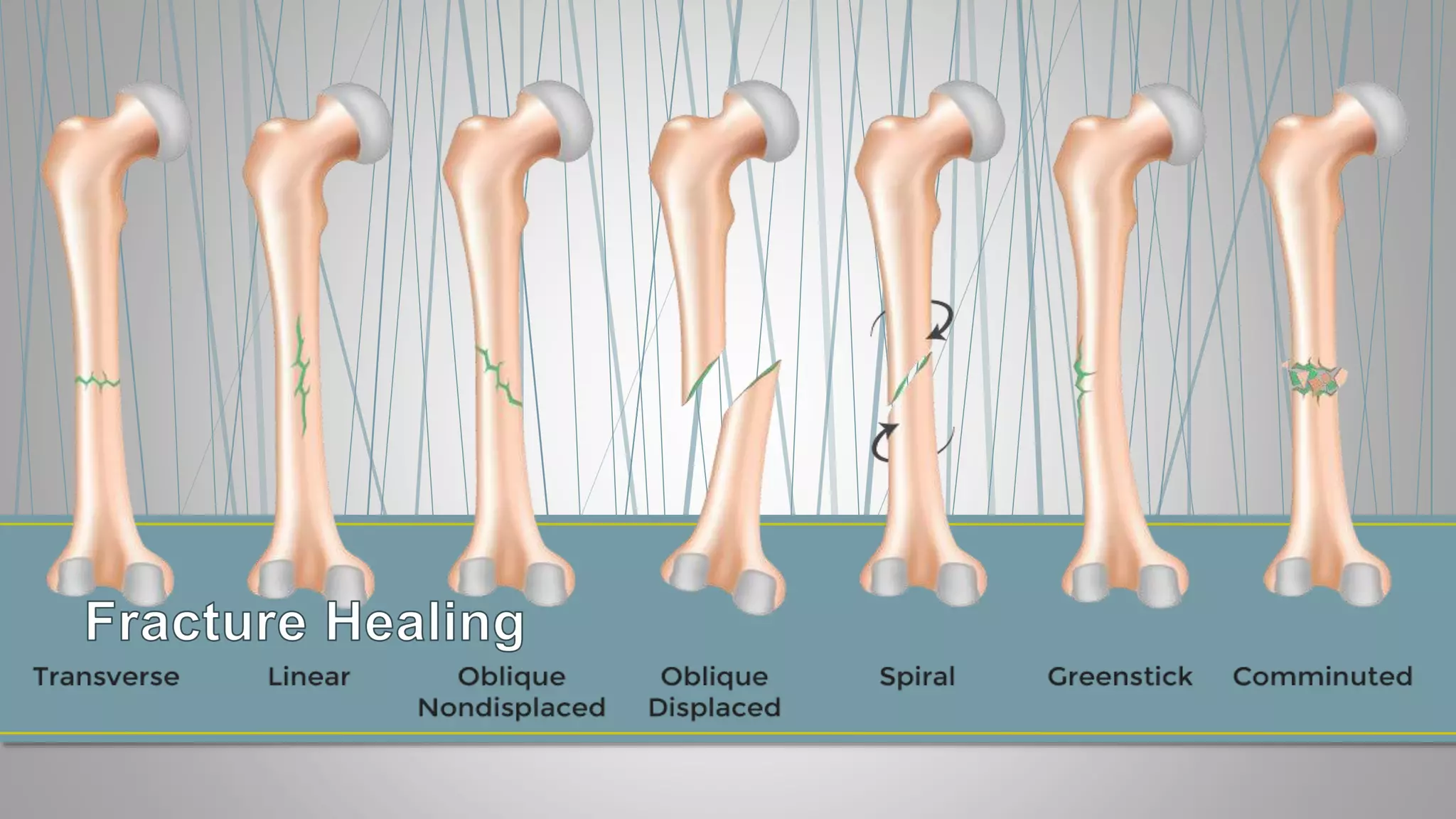 4. healing and fracture | PPT