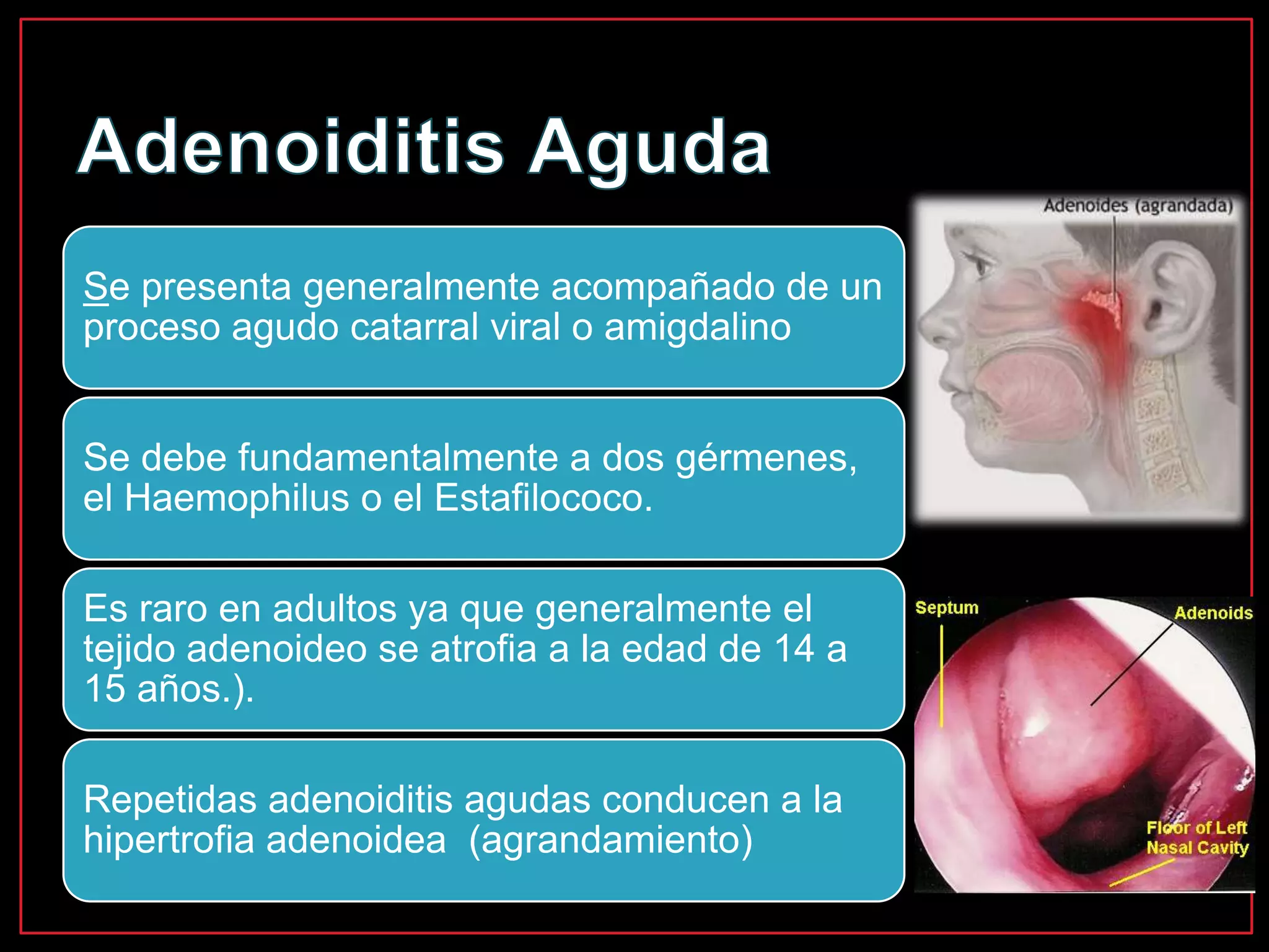 4. adenoiditis e hipertrofia adenoidea | PPTX