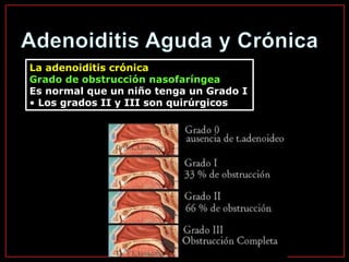 4. adenoiditis e hipertrofia adenoidea | PPTX
