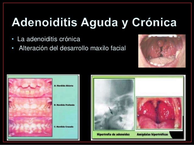 4. adenoiditis e hipertrofia adenoidea