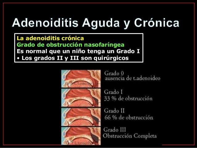4. adenoiditis e hipertrofia adenoidea