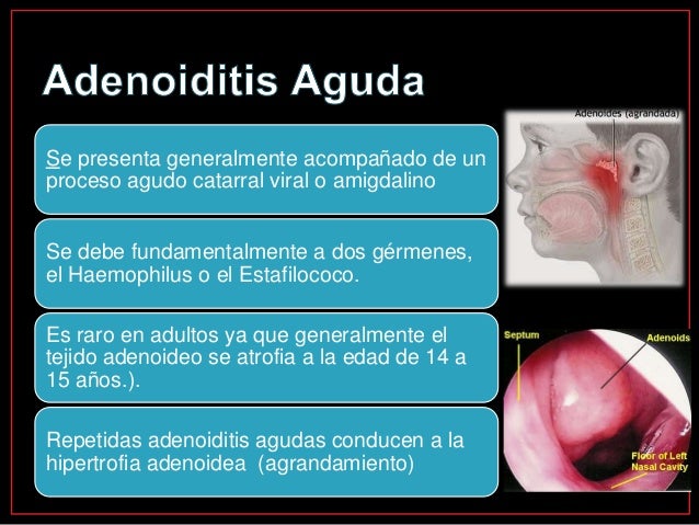 4. adenoiditis e hipertrofia adenoidea