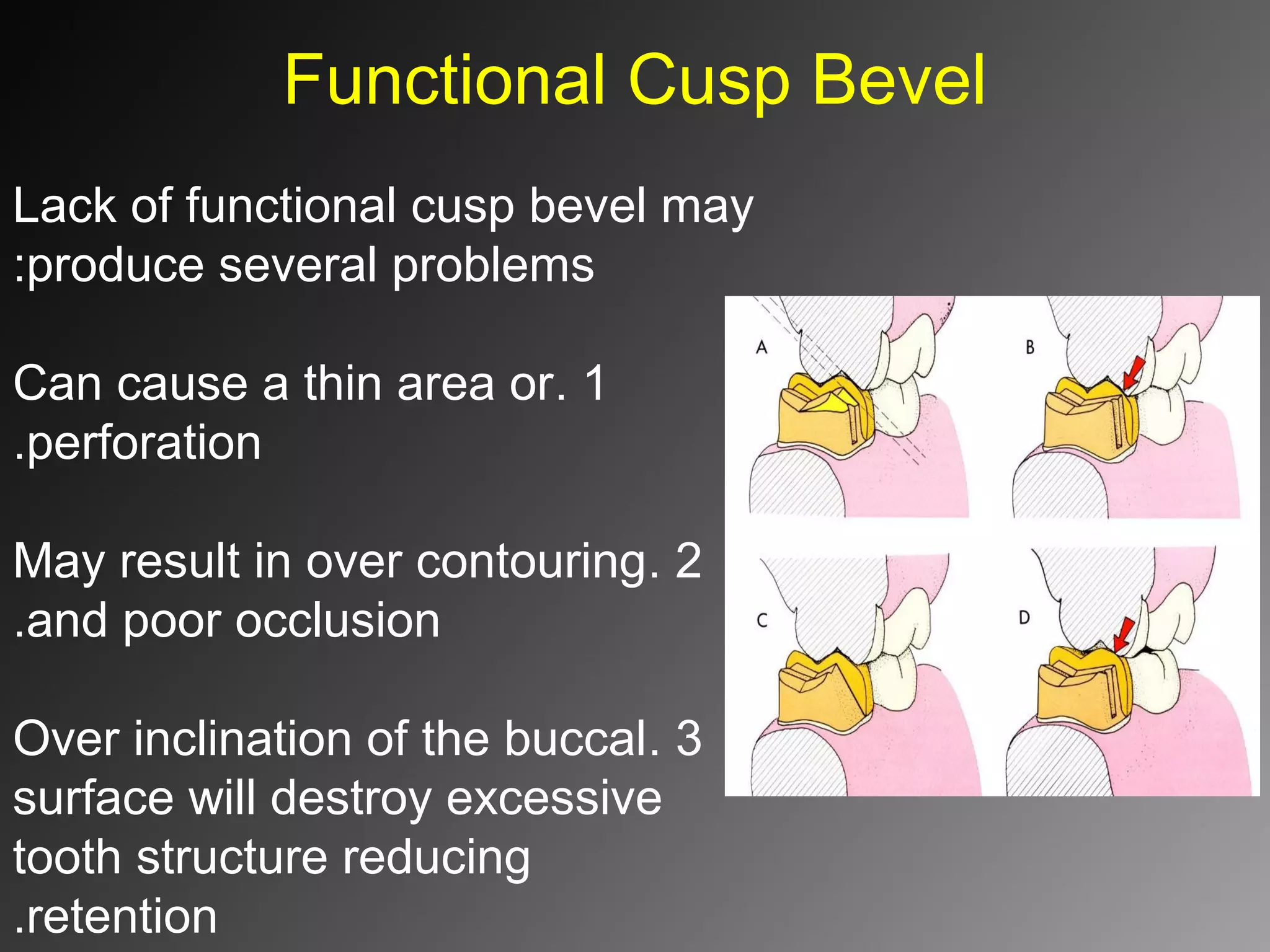 4.principles of tooth preparation ‫‬ | PPT