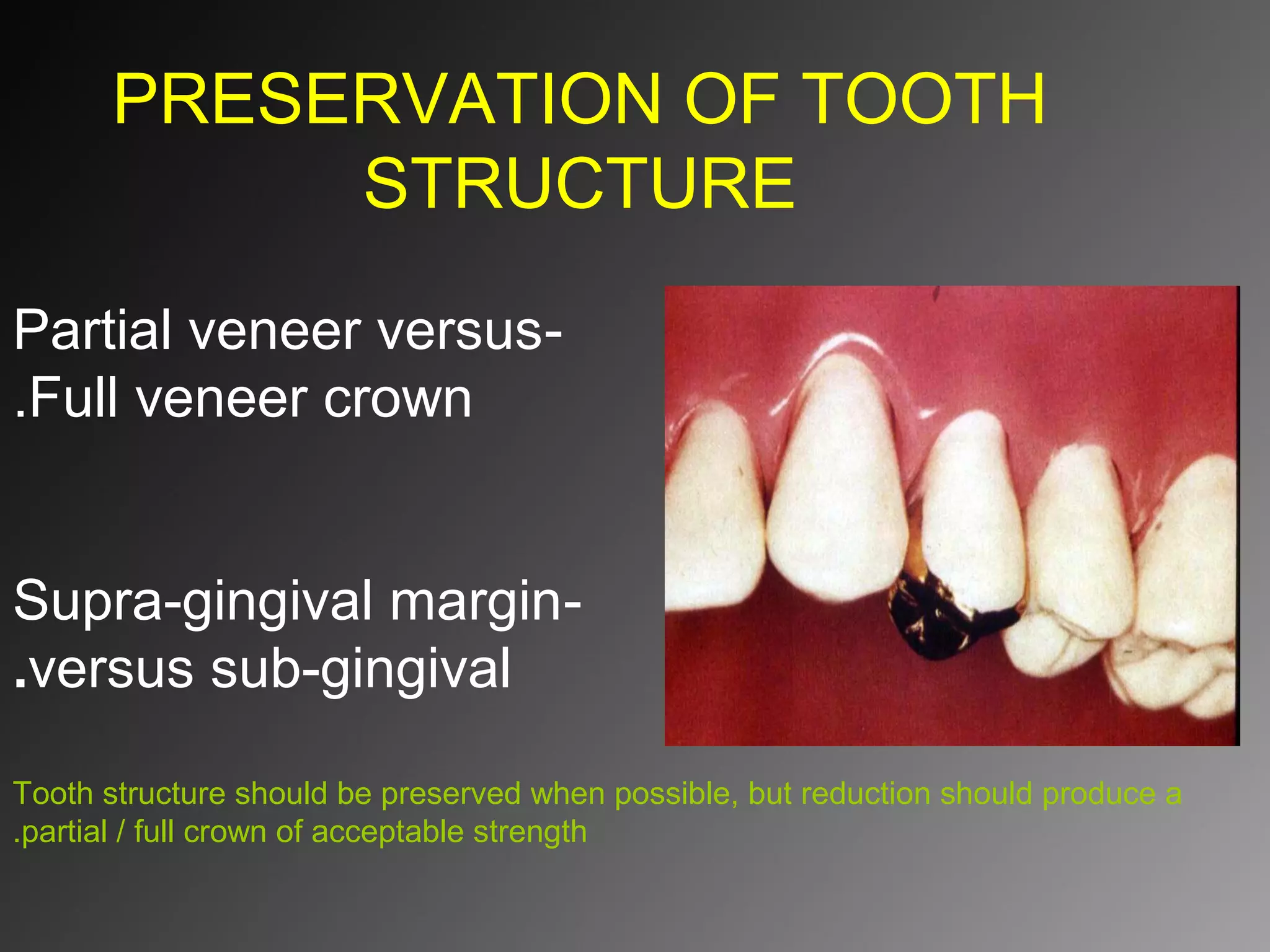 4.principles of tooth preparation ‫‬ | PPT