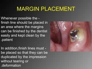 4.principles of tooth preparation ‫‬ | PPT