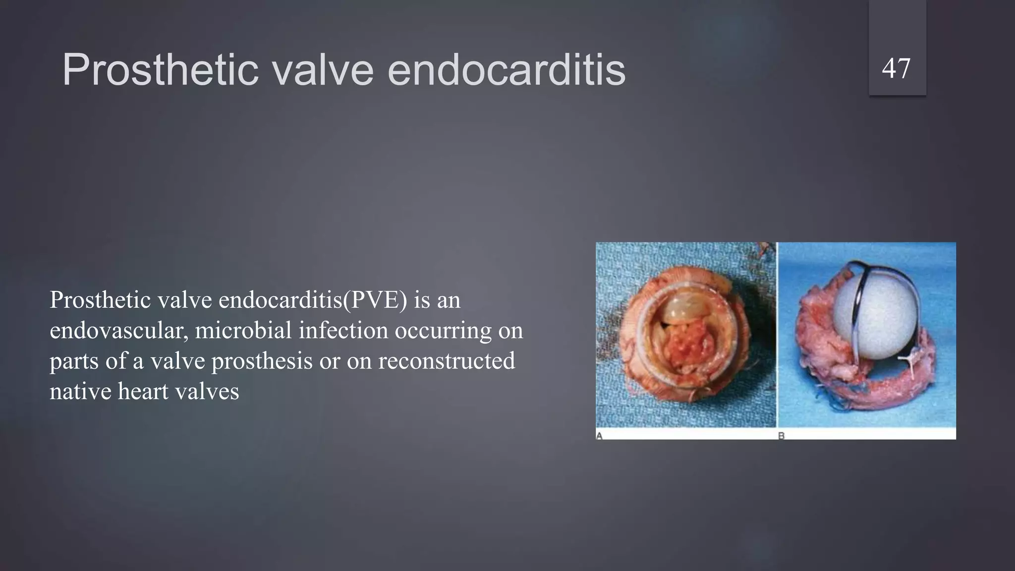 infective endocarditis- dental applications | PPTX