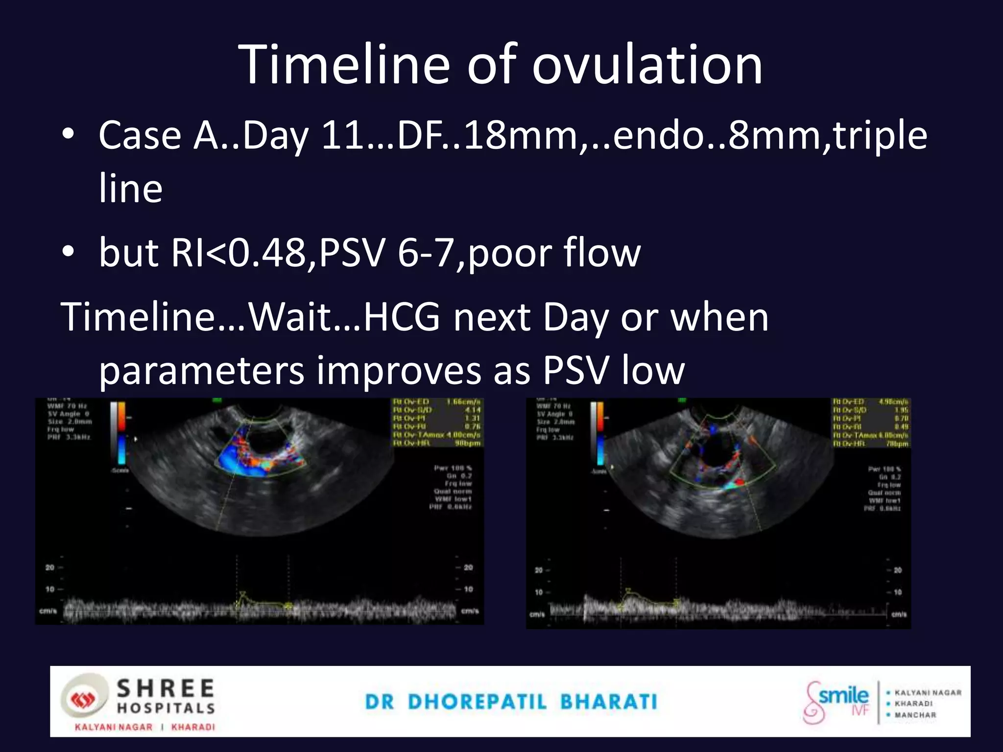 Ovulation Induction - Simplified - Dr Dhorepatil Bharati | PPTX