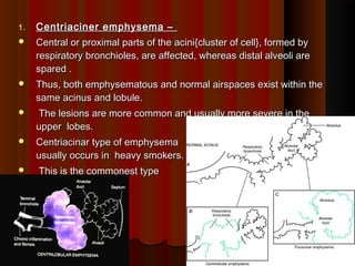 4.copd