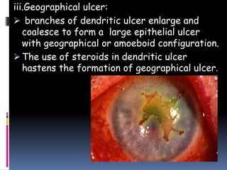 4.fungal and viral keratitis | PPTX
