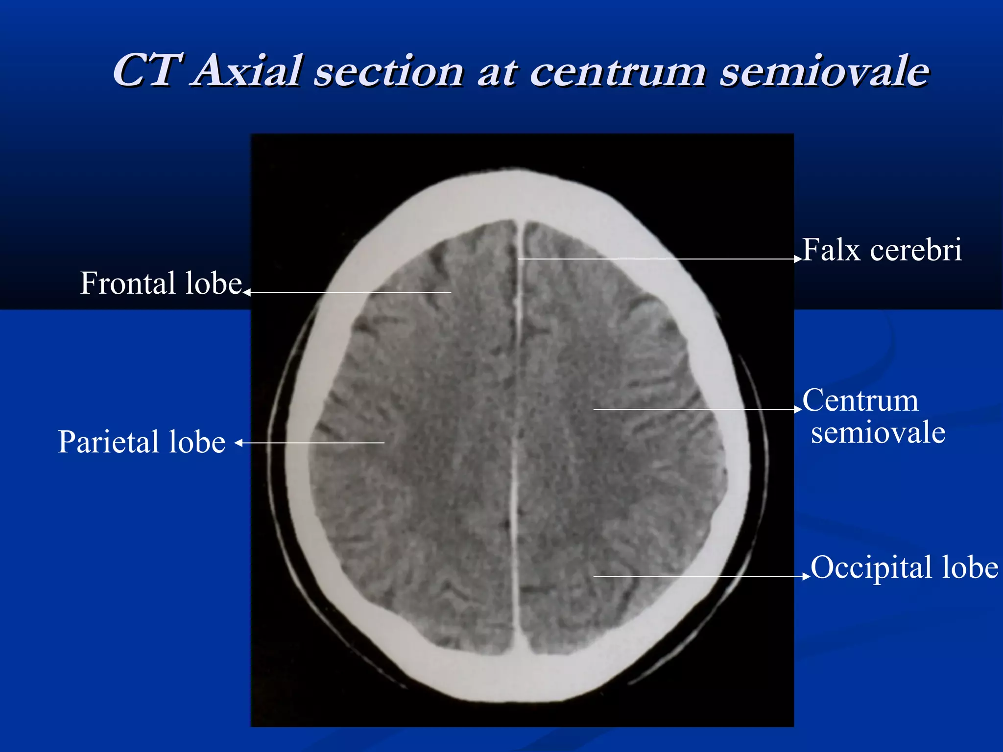 Radiological Techniques of brain Space occupying lesion | PPT