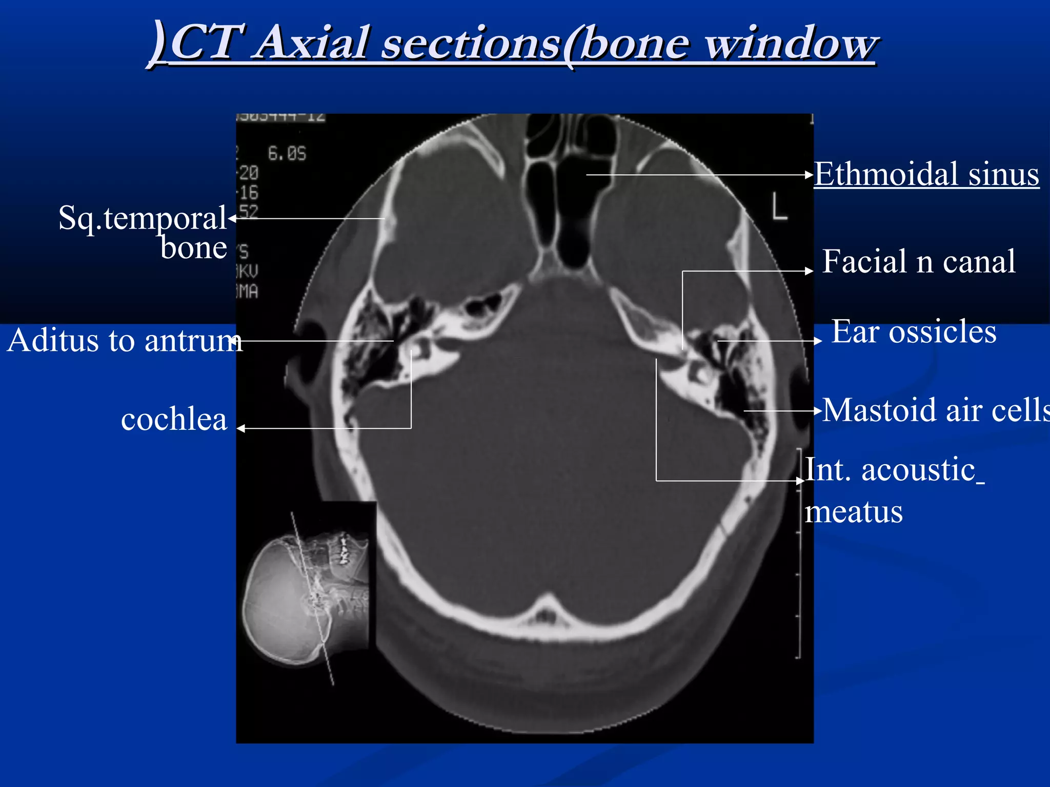 Radiological Techniques of brain Space occupying lesion | PPT