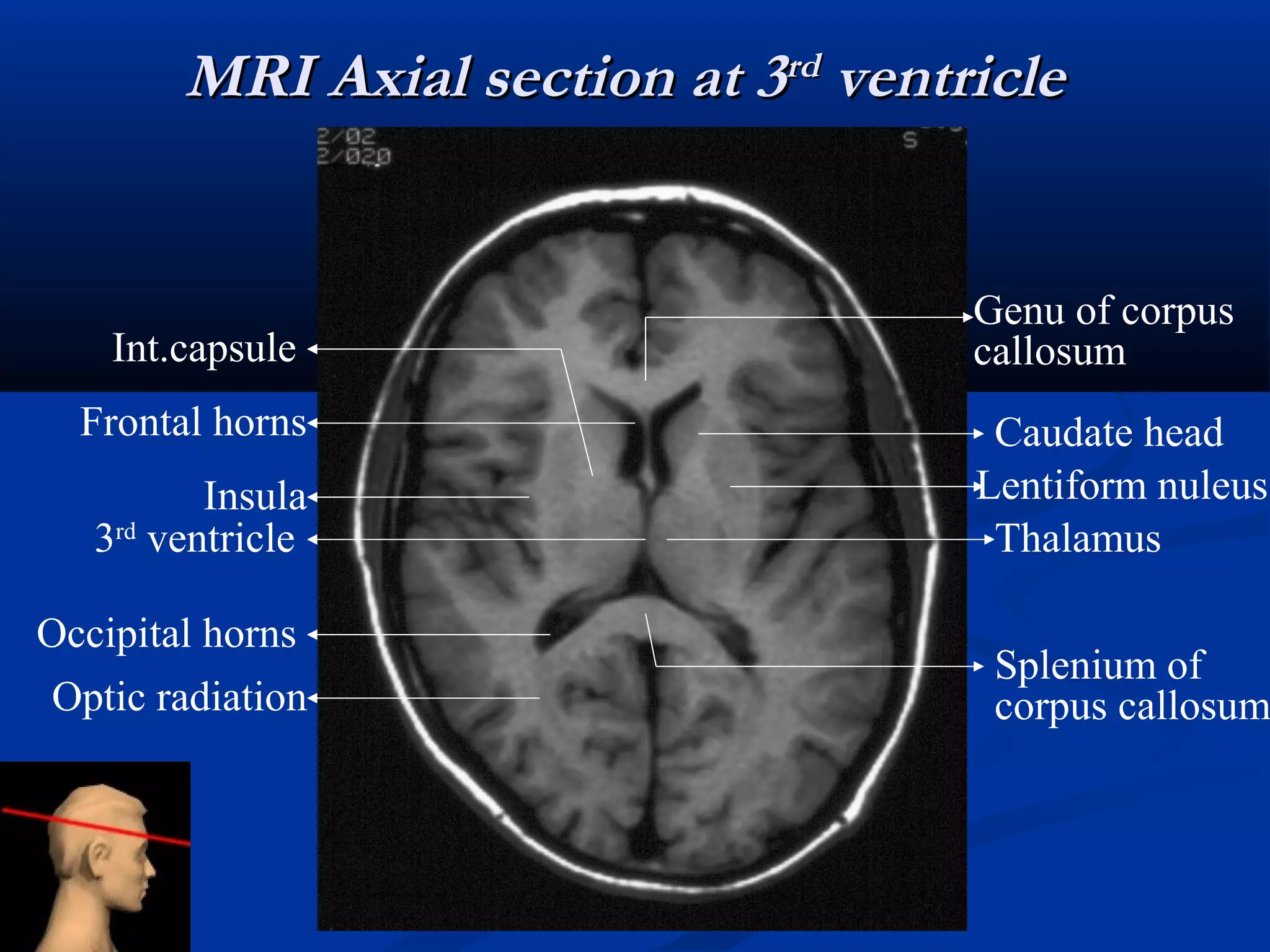Radiological Techniques of brain Space occupying lesion | PPT