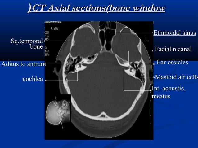 Radiological Techniques of brain Space occupying lesion | PPT
