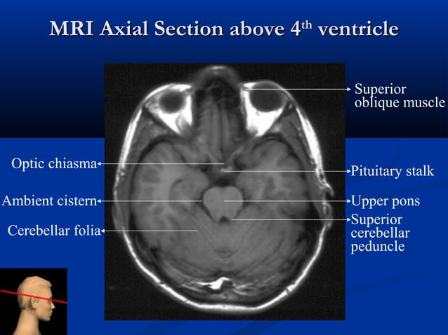 Radiological Techniques of brain Space occupying lesion | PPT