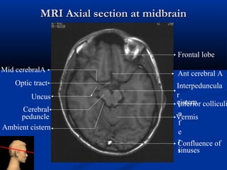 Radiological Techniques of brain Space occupying lesion | PPT