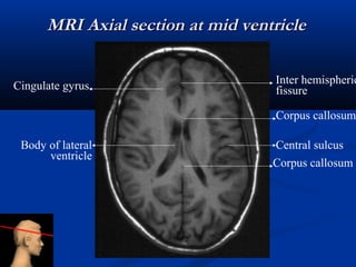 Radiological Techniques of brain Space occupying lesion | PPT