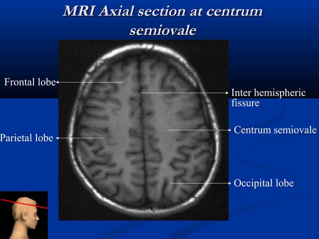 Radiological Techniques of brain Space occupying lesion | PPT
