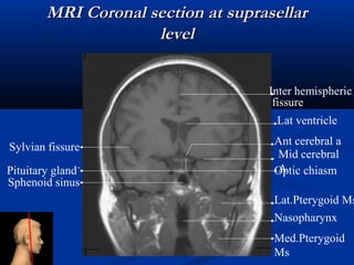Radiological Techniques of brain Space occupying lesion | PPT