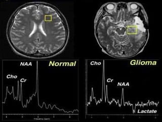 Radiological Techniques of brain Space occupying lesion | PPT