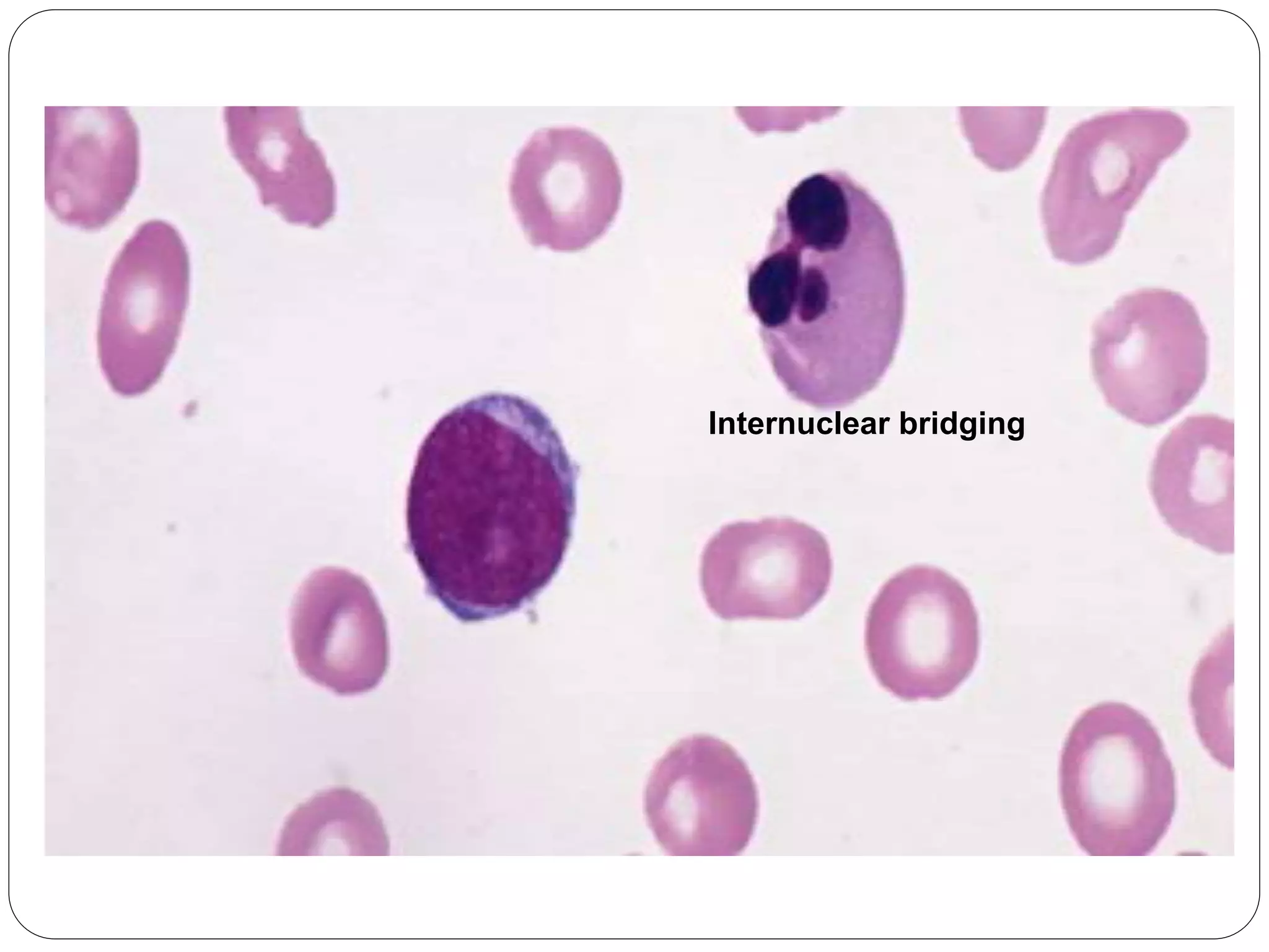 Myelodysplastic Syndrome | PPTX