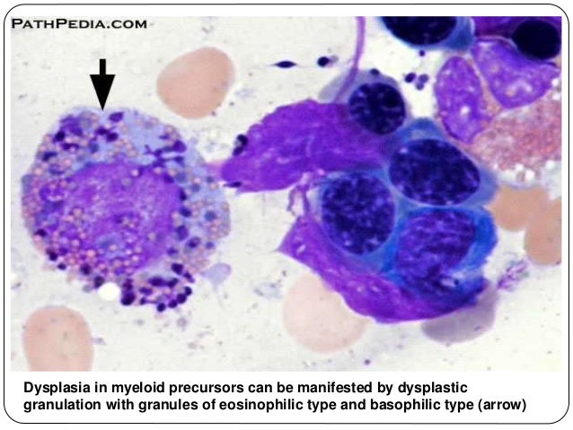 Myelodysplastic Syndrome