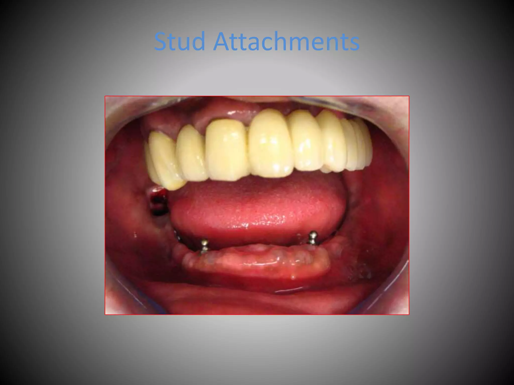 4. attachments for over dentures(1) | PPTX