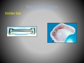 4. attachments for over dentures(1) | PPTX
