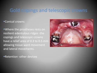 4. attachments for over dentures(1) | PPTX