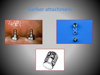 4. attachments for over dentures(1) | PPTX
