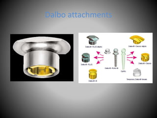 4. attachments for over dentures(1) | PPTX