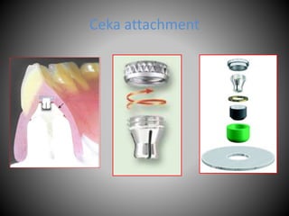4. attachments for over dentures(1) | PPTX