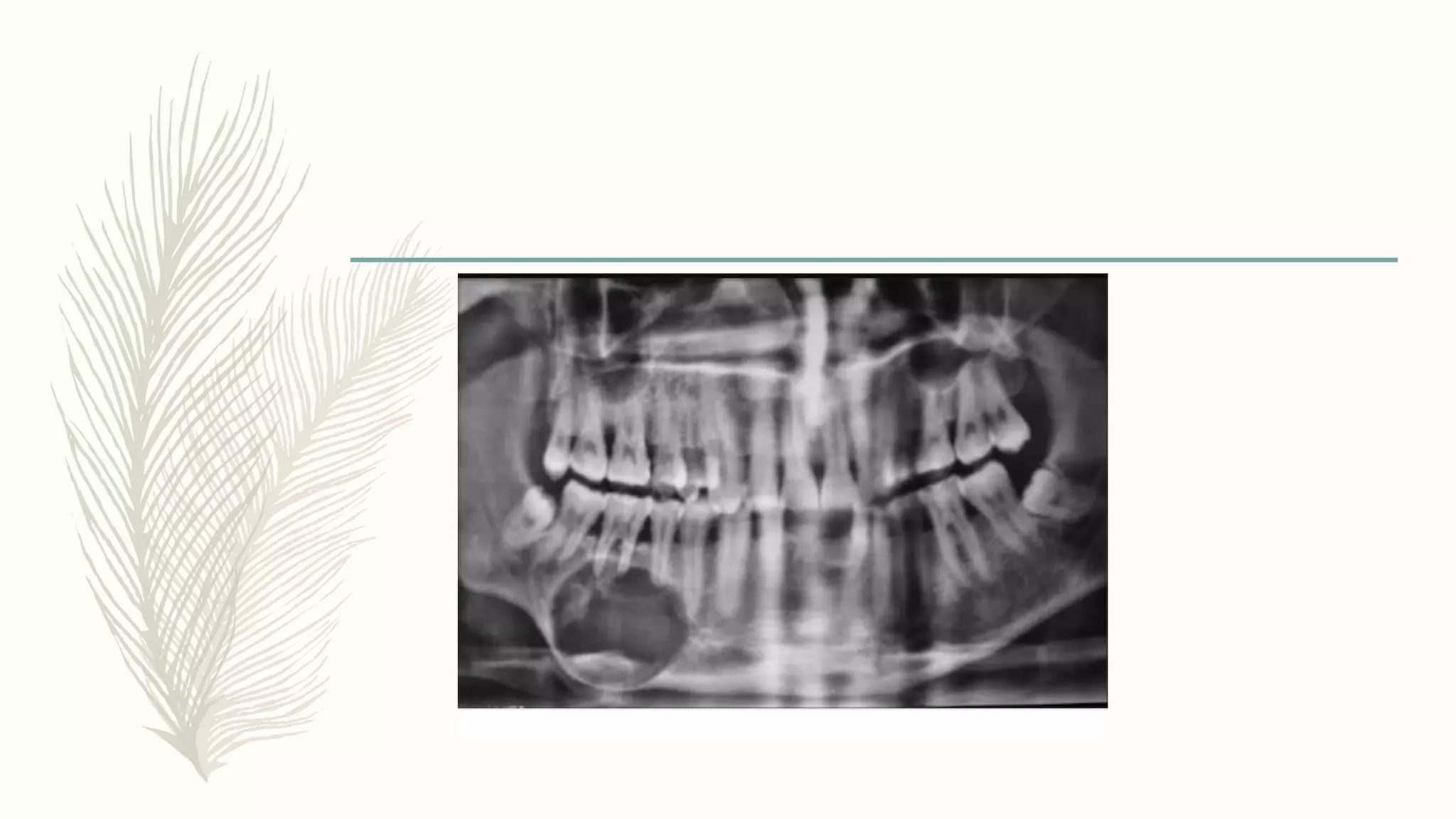 ossifying fibroma and cemental dysplasia | PPTX